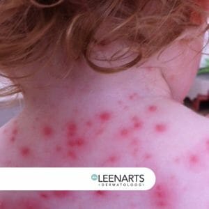 Waterpokken en vliegen? - Dokter Leenarts, dermatoloog