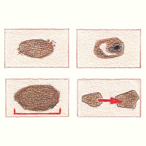 Moedervlekken. Check je atypische moedervlek: ABCDE methode | Drs Leenarts