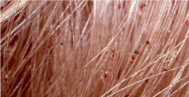 Meer luizen na vakantie? | Drs Leenarts, dermatoloog