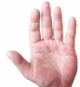 Eczeem aan je handen? Behandeling & tips bij handeczeem | Drs Leenarts