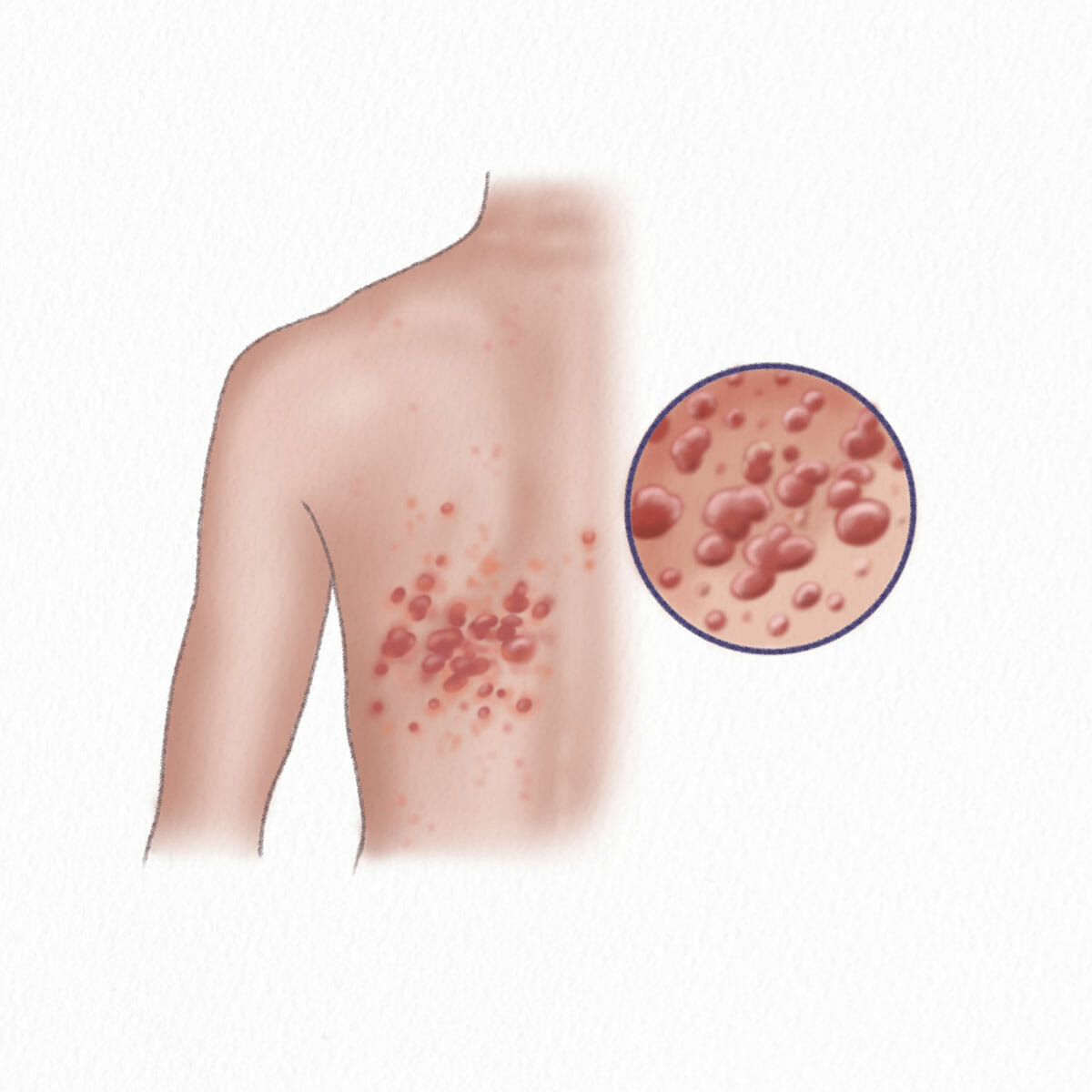 Urticaria | netelroos, galbulten | Drs Leenarts | Dermatoloog