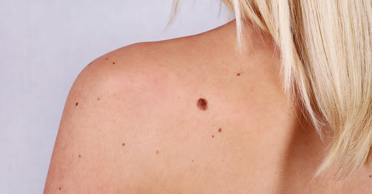 Jeukende moedervlek. Kan het kwaad? | Drs Leenarts | Dermatoloog Jeukende moedervlek. Kan het kwaad? | Drs Leenarts | Dermatoloog