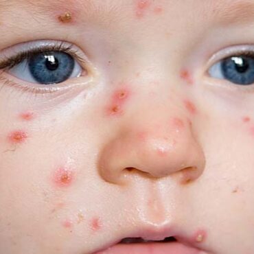 Waterpokken bij volwassenen | Oorzaak & tips | Drs Leenarts