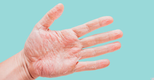 Smetplekken | oorzaak en behandelen | Drs Leenarts