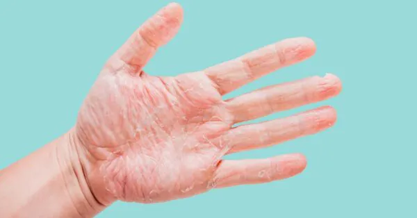 Smetplekken | oorzaak en behandelen | Drs Leenarts