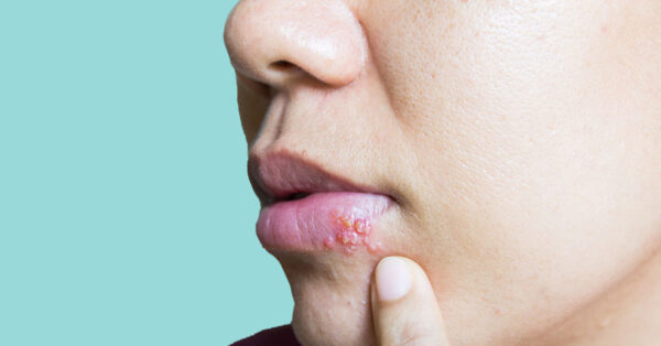 Wat is gordelroos | oorzaak, verloop en tips | Drs Leenarts