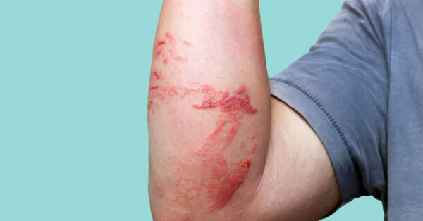 Huiduitslag eikenprocessierups | Drs Leenarts | Dermatoloog