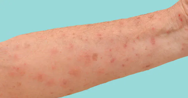 Hoofdluis | herkennen, behandelen | Drs Leenarts Dermatoloog