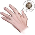 Schurft (scabiës) | oorzaak, klachten & tips | Drs Leenarts | Dermatoloog