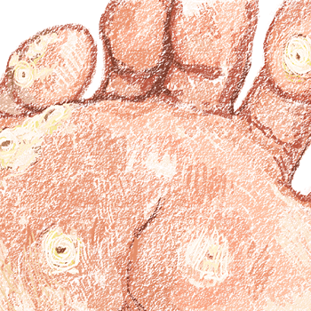 Wratten | oorzaak, behandeling en tips | Drs Leenarts Dermatoloog