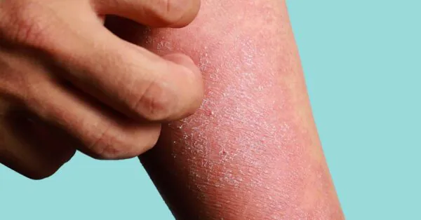 Handeczeem | oorzaak en behandeling | Drs Leenarts