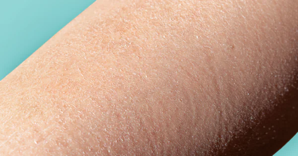 Witte vlekken op de huid | oorzaak en tips | Drs Leenarts