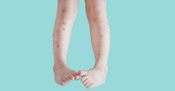 Muggenbulten herkennen & behandelen | Tips van Drs Leenarts