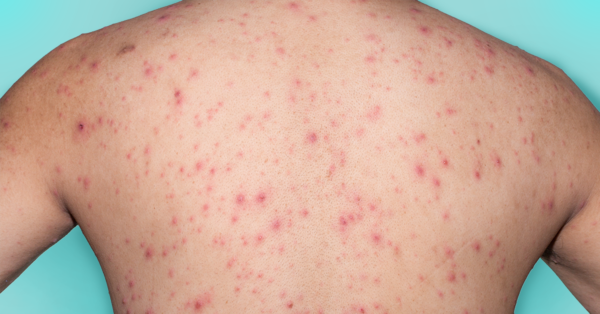 Waterpokken bij baby en kind | Advies & tips | Drs Leenarts