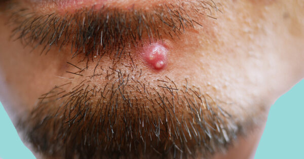 Gerstekorrels? Zo kom je ervan af! | Dermatoloog Leenarts