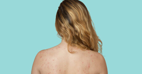 Puisten op de rug: wat kun je ertegen doen? | Drs Leenarts