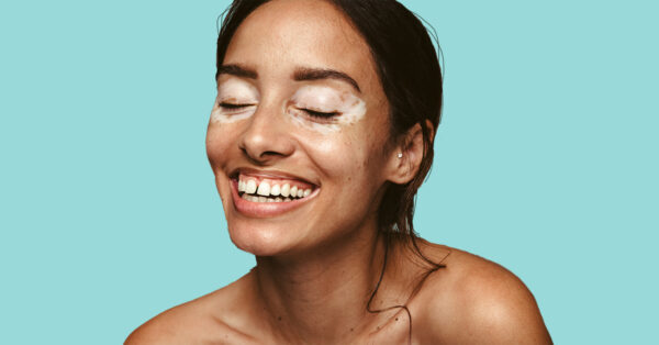 Littekens | Verloop, klachten, verzorgen | Drs Leenarts