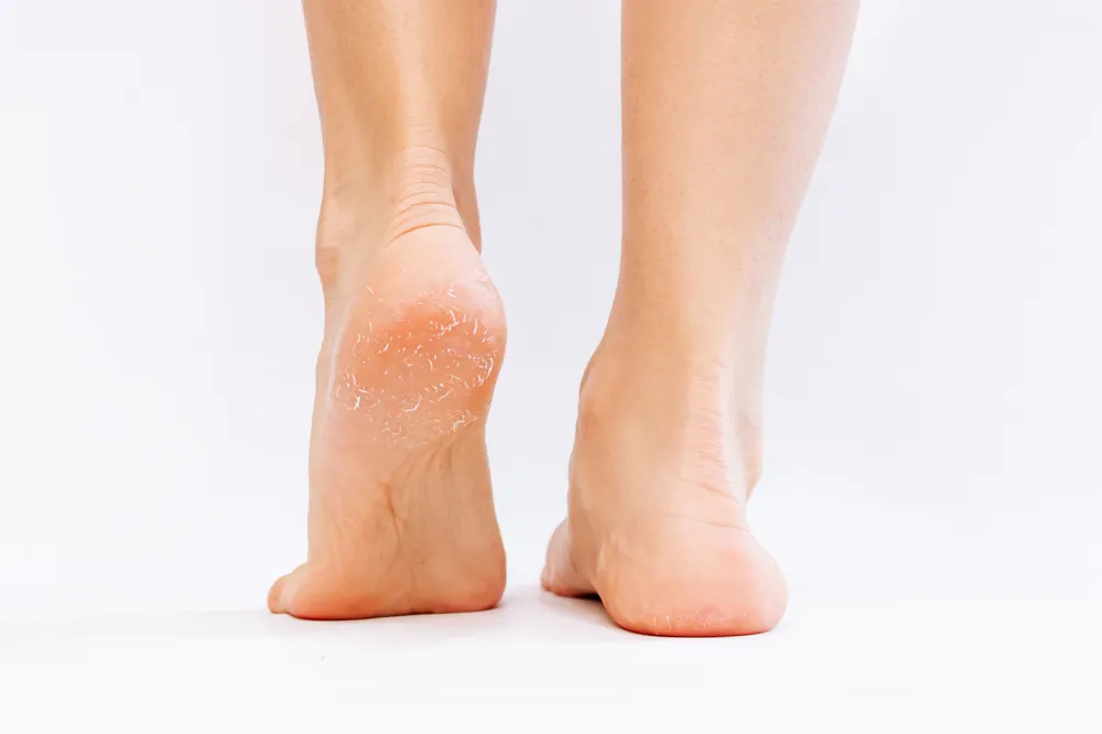 Eelt verwijderen op voeten | Drs Leenarts